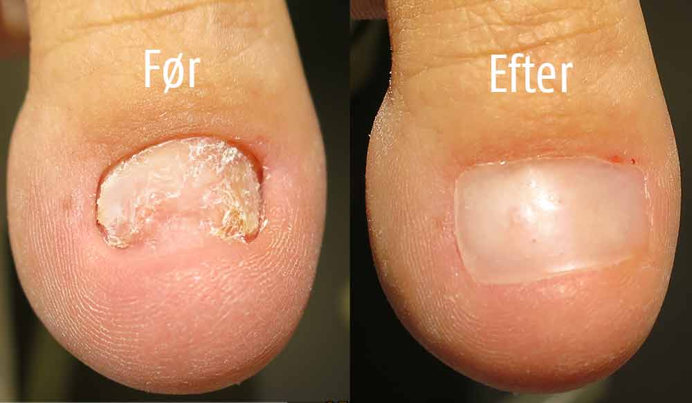 Ørestad Klinik for Fodterapi - fodexpert.dk - Negleproteser
